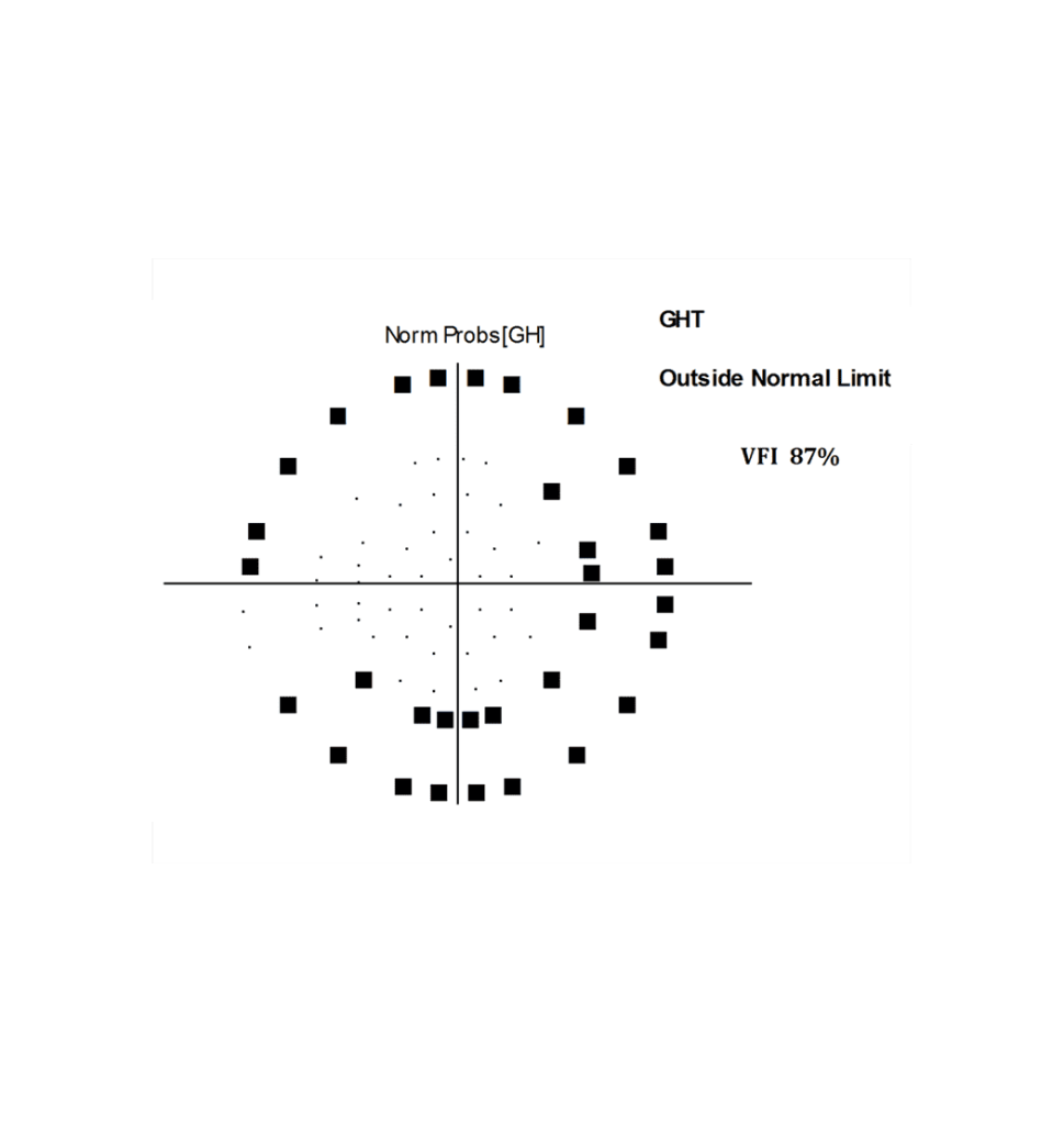 APPA Auto Perimeter AP901 CTS for Accurate Glaufield Diagnostics
